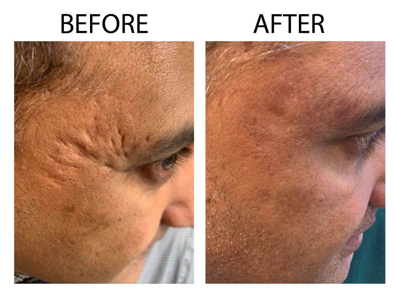 Micro-Needling - SMP Lasers